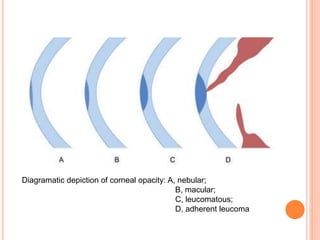 Corneal opacity | PPTX