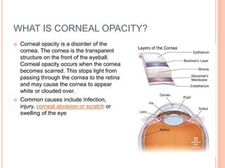 Corneal opacity | PPTX