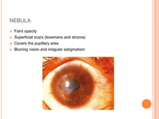 Corneal opacity | PPTX
