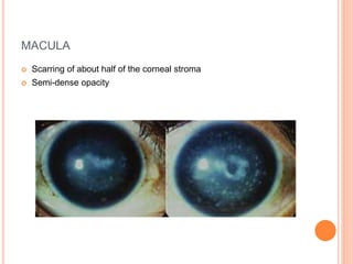 Corneal opacity | PPTX