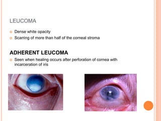 Corneal opacity | PPTX