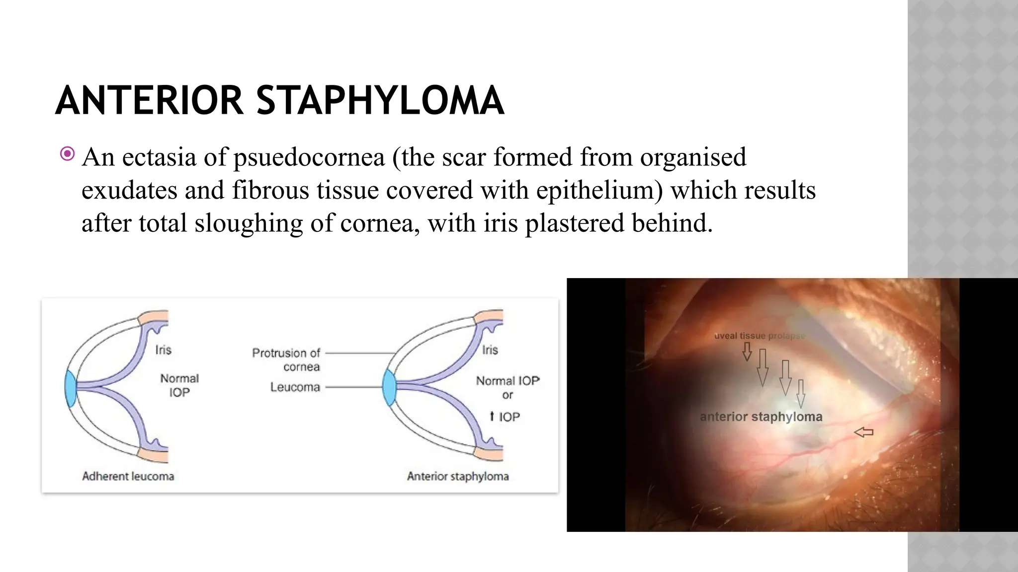CORNEAL OPACITY.pptx,corneal opacity, types/grades. clinical features ...
