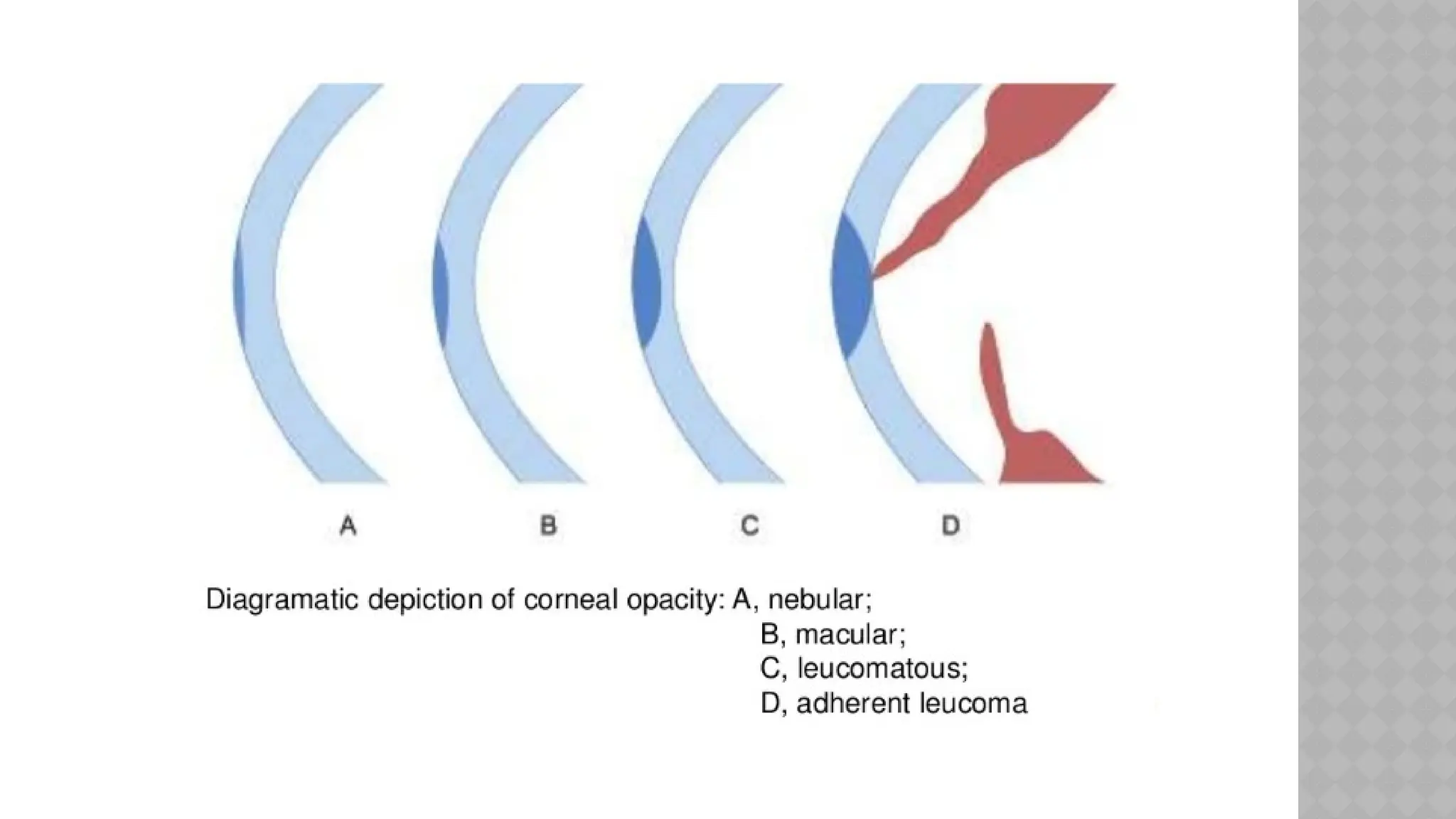 CORNEAL OPACITY.pptx,corneal opacity, types/grades. clinical features ...