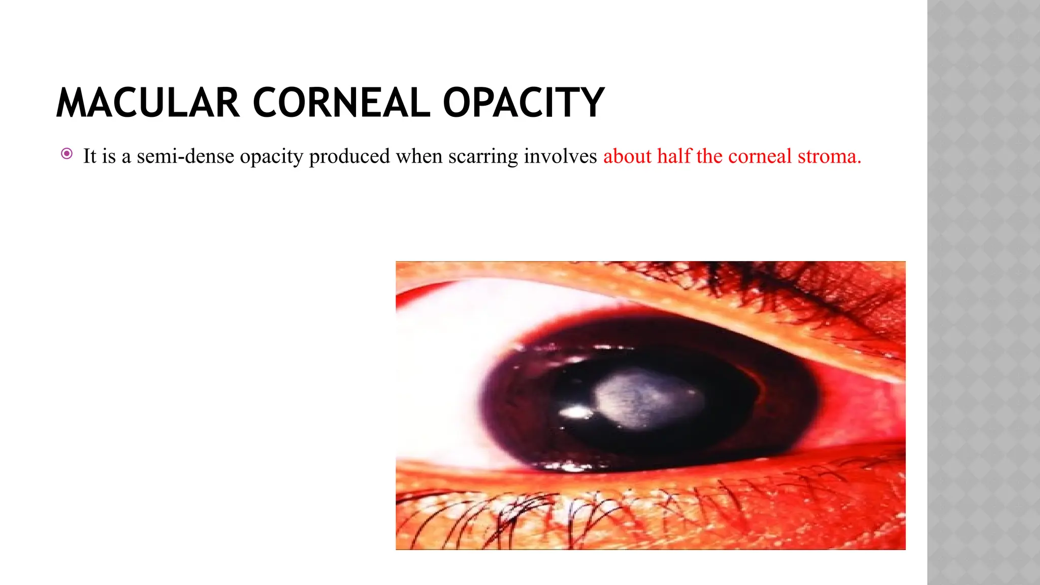 CORNEAL OPACITY.pptx,corneal opacity, types/grades. clinical features ...
