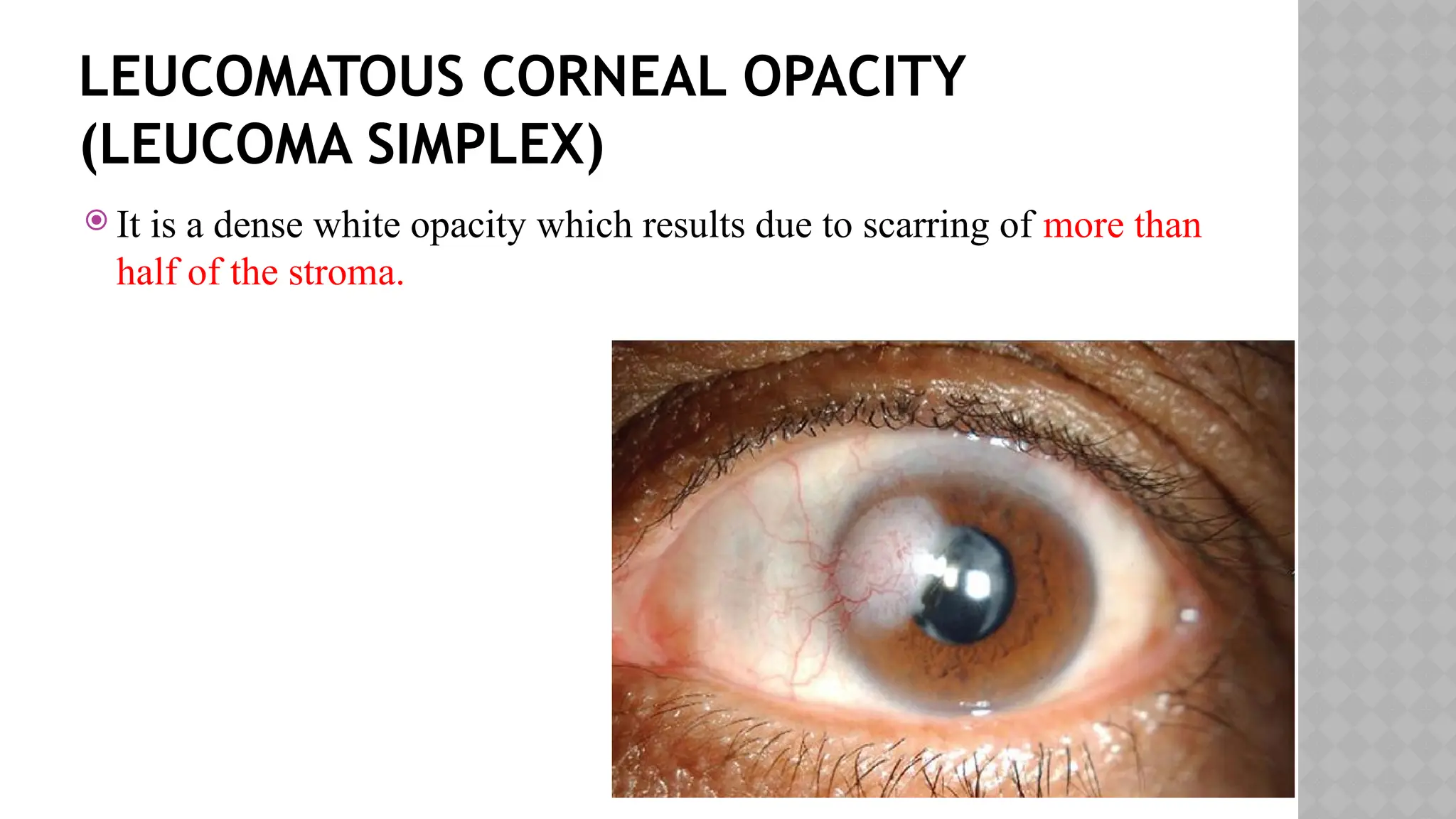 CORNEAL OPACITY.pptx,corneal opacity, types/grades. clinical features ...