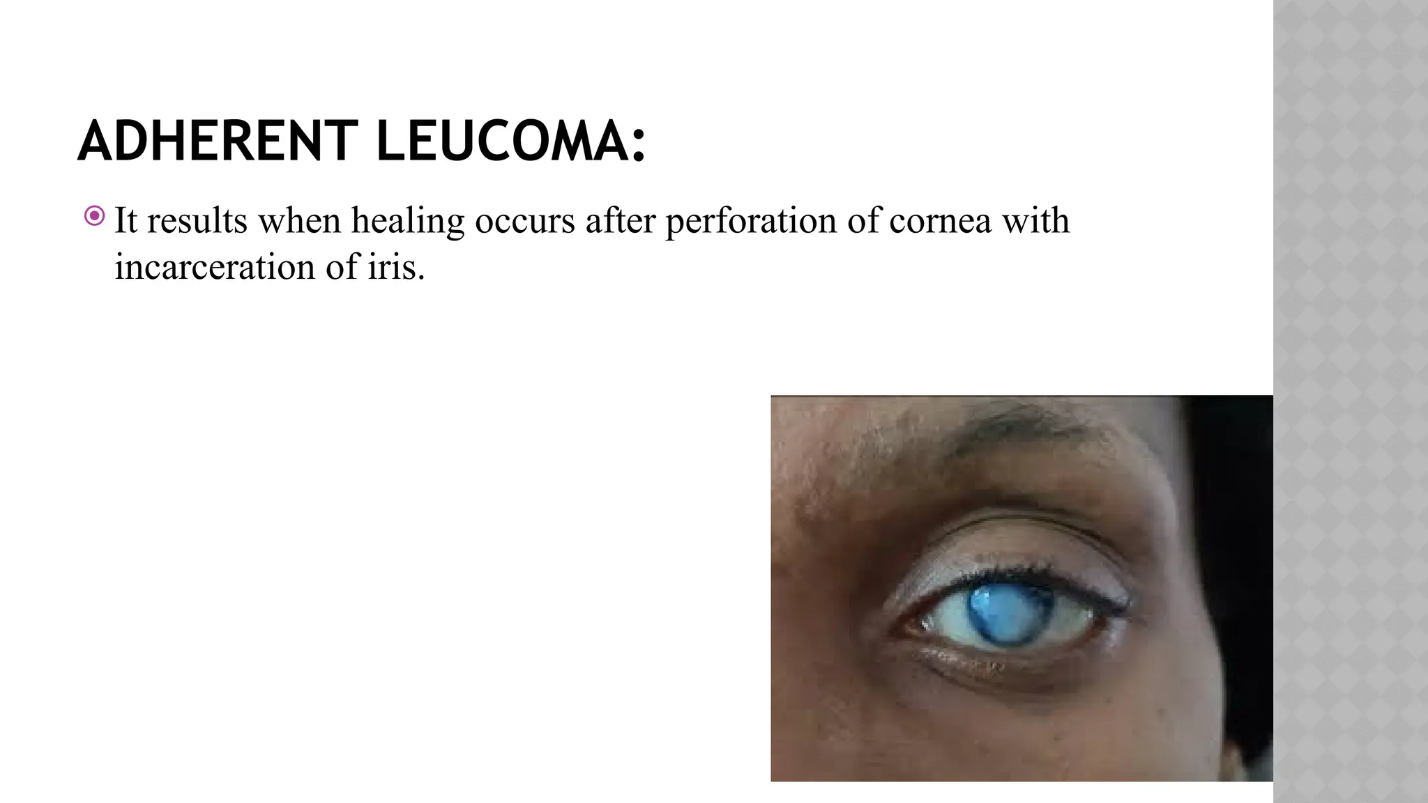 CORNEAL OPACITY.pptx,corneal opacity, types/grades. clinical features ...