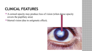 CORNEAL OPACITY.pptx,corneal opacity, types/grades. clinical features ...