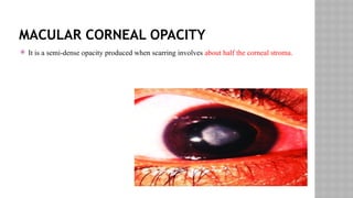 CORNEAL OPACITY.pptx,corneal opacity, types/grades. clinical features ...