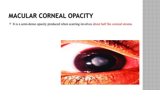 CORNEAL OPACITY.pptx,corneal opacity, types/grades. clinical features ...