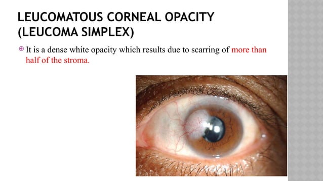 CORNEAL OPACITY.pptx,corneal opacity, types/grades. clinical features ...