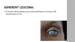 CORNEAL OPACITY.pptx,corneal opacity, types/grades. clinical features ...