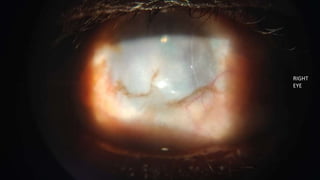 Corneal Opacity case | PPTX