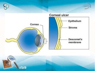 Corneal perforation | PPTX