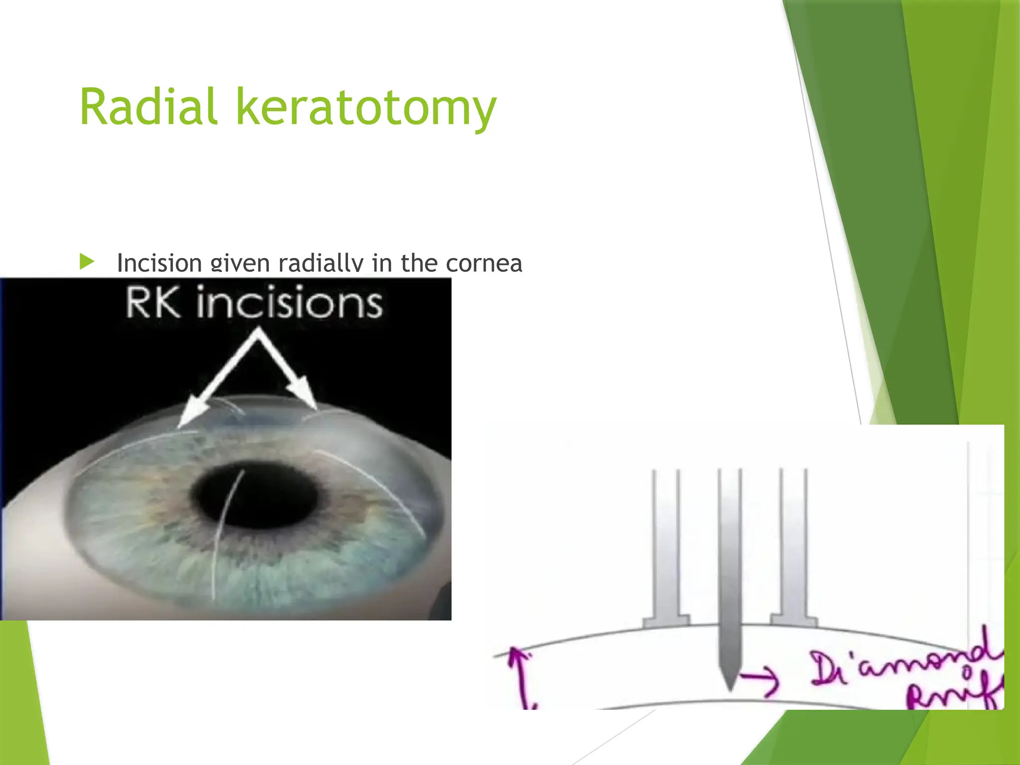 corneal refractive surgeries presenters | PPTX