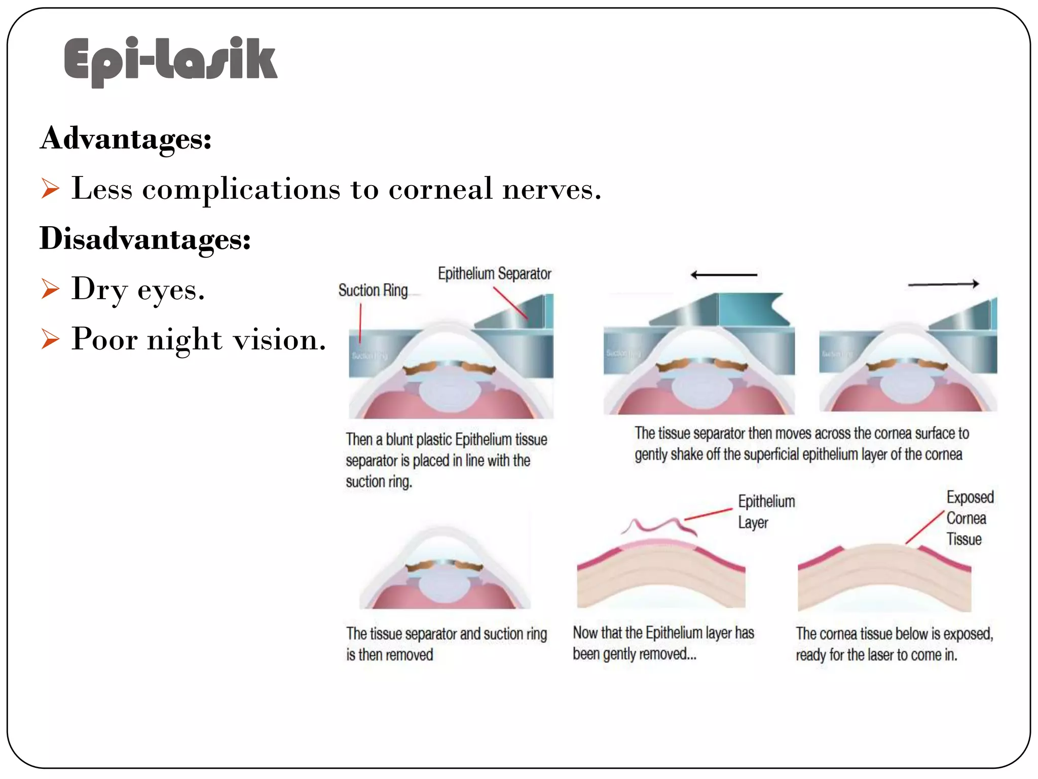 Corneal refractive surgery | PPTX