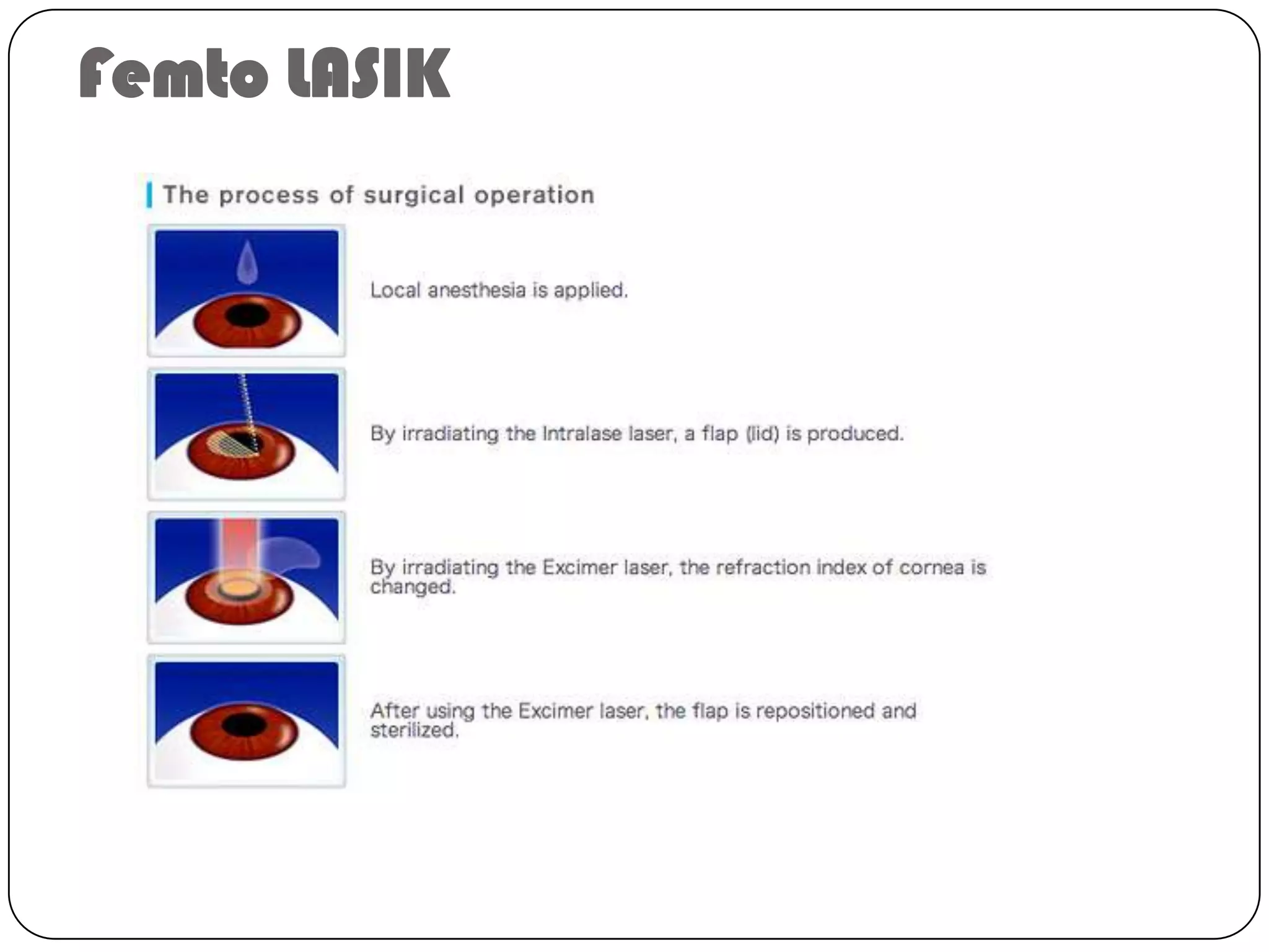 Corneal refractive surgery | PPTX