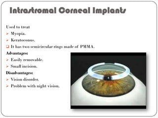 Corneal refractive surgery | PPTX