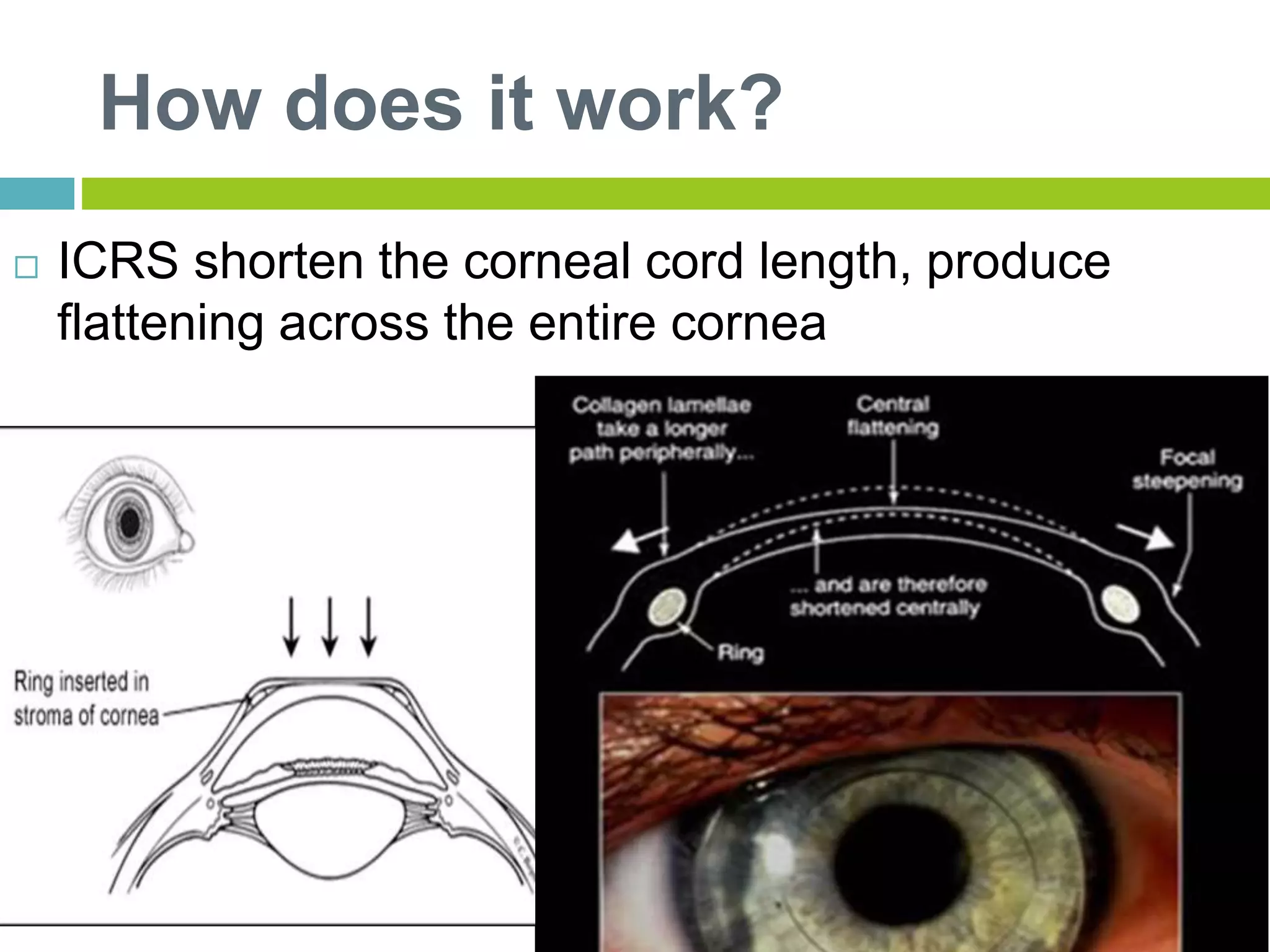 Corneal rings | PPTX