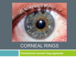 Corneal rings | PPTX
