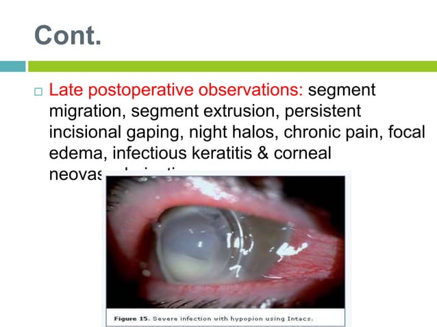 Corneal rings | PPTX