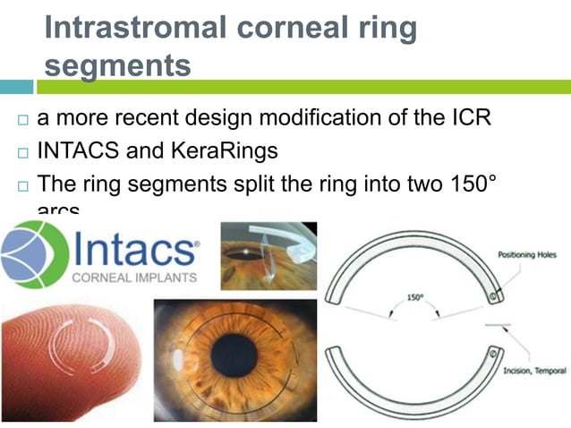Corneal rings | PPT | Free Download