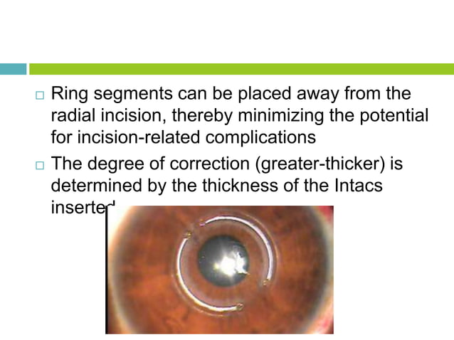 Corneal rings | PPTX