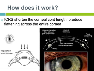 Corneal rings | PPTX
