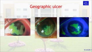 Corneal signs ppt | PPTX