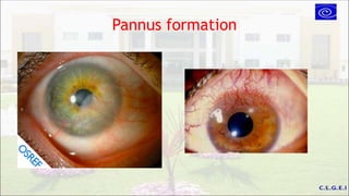 Corneal signs ppt | PPTX | Death, Injury, or Military Conflict ...