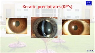 Corneal signs ppt | PPT
