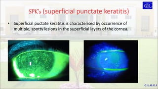 Corneal signs ppt | PPTX | Death, Injury, or Military Conflict ...