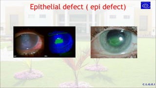 Corneal signs ppt | PPTX | Death, Injury, or Military Conflict ...
