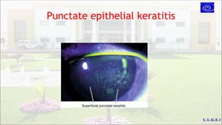 Corneal signs ppt | PPTX | Death, Injury, or Military Conflict ...