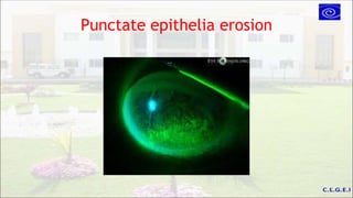 Corneal signs ppt | PPTX | Death, Injury, or Military Conflict ...