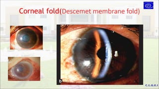 Corneal signs ppt | PPT