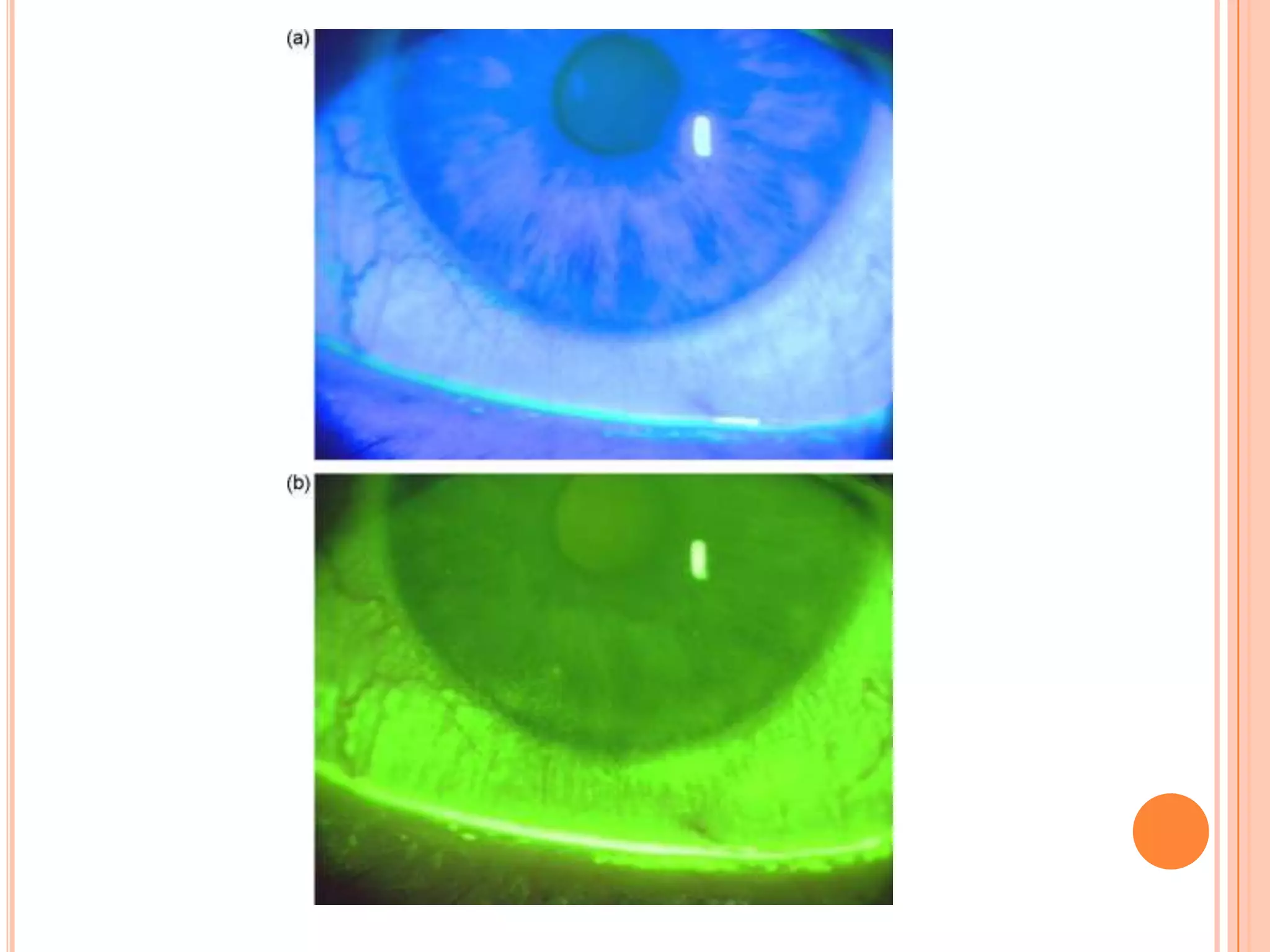 Corneal staining | PPTX