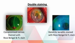 Different types of Corneal Staining.pptx