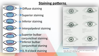 Different types of Corneal Staining.pptx