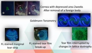 Different types of Corneal Staining.pptx
