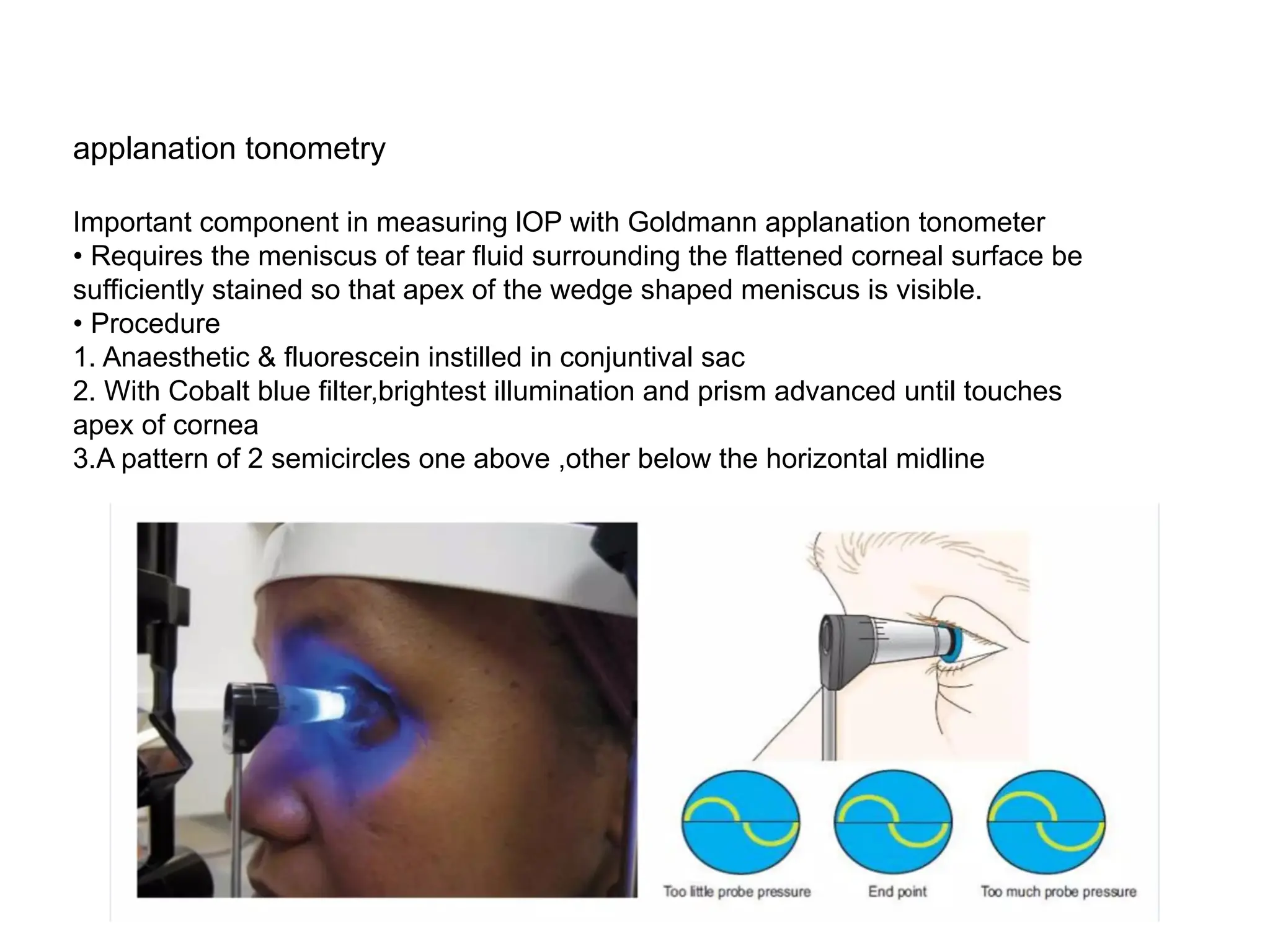 corneal staining including fluorescien, lissamine green and rose bengal ...