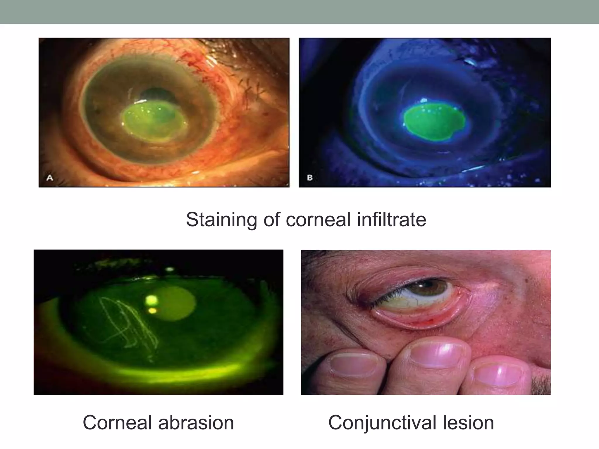 Corneal staining procedure | PPTX