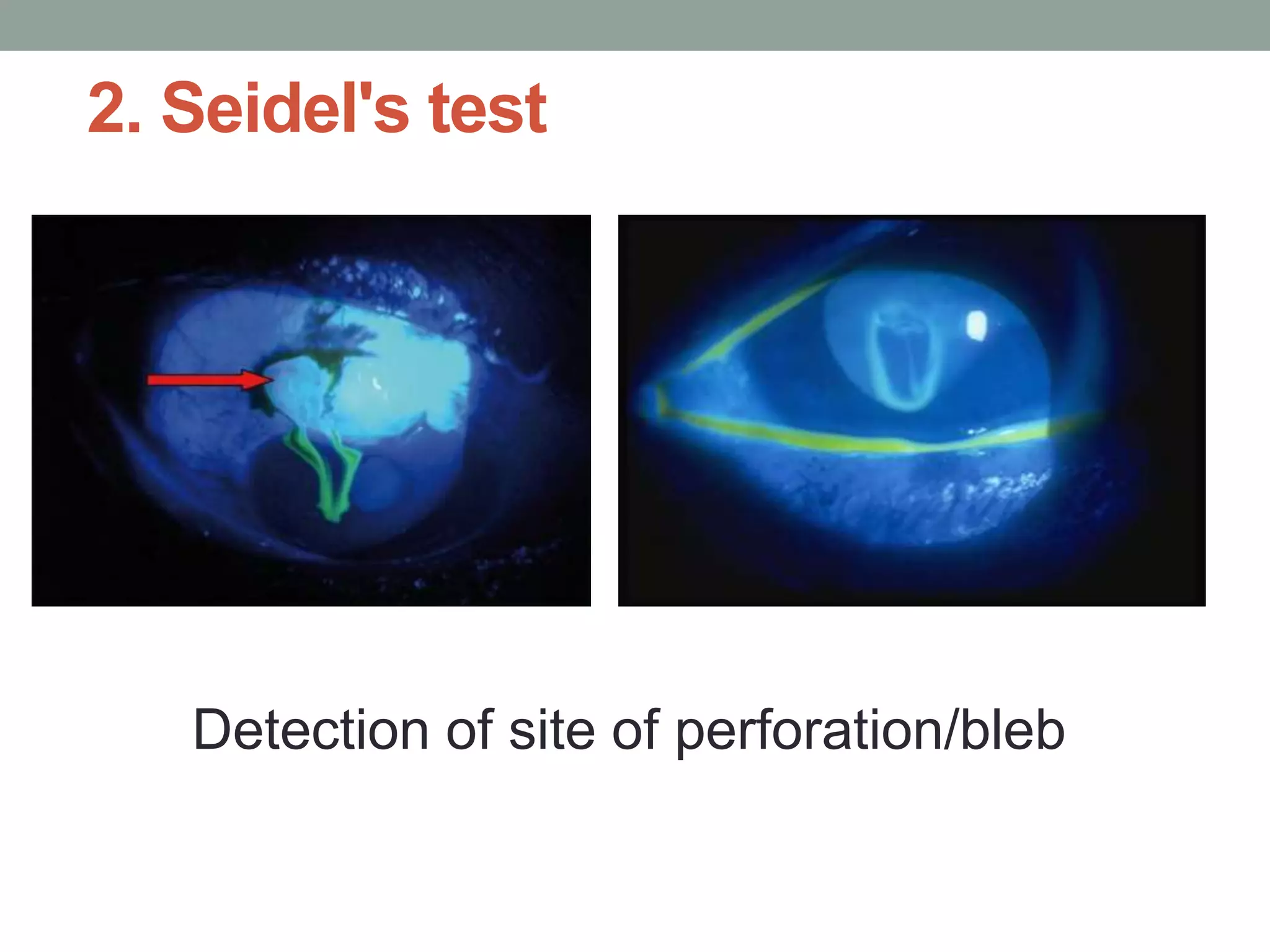 Corneal staining procedure | PPTX