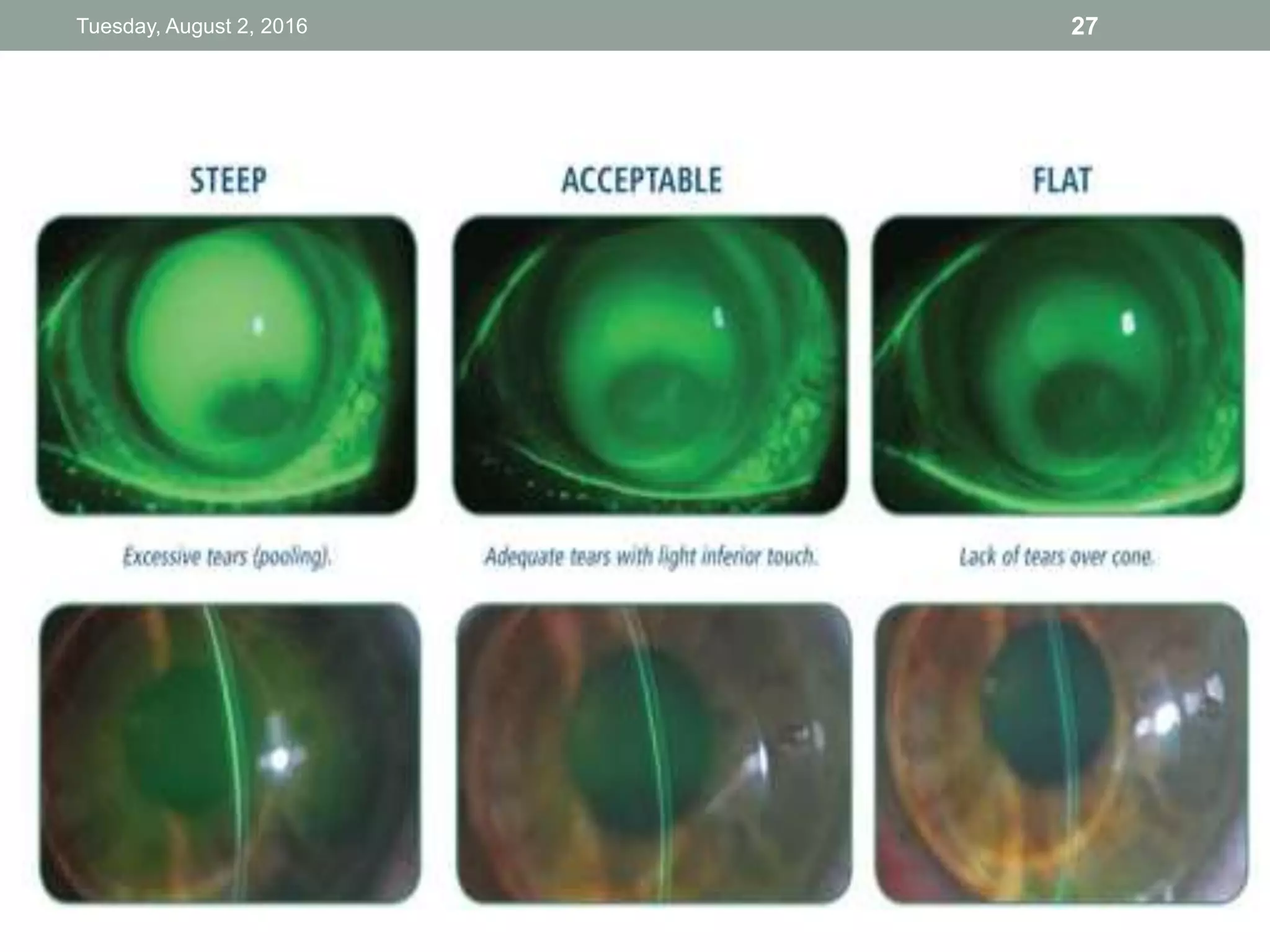 Corneal staining procedure | PPTX