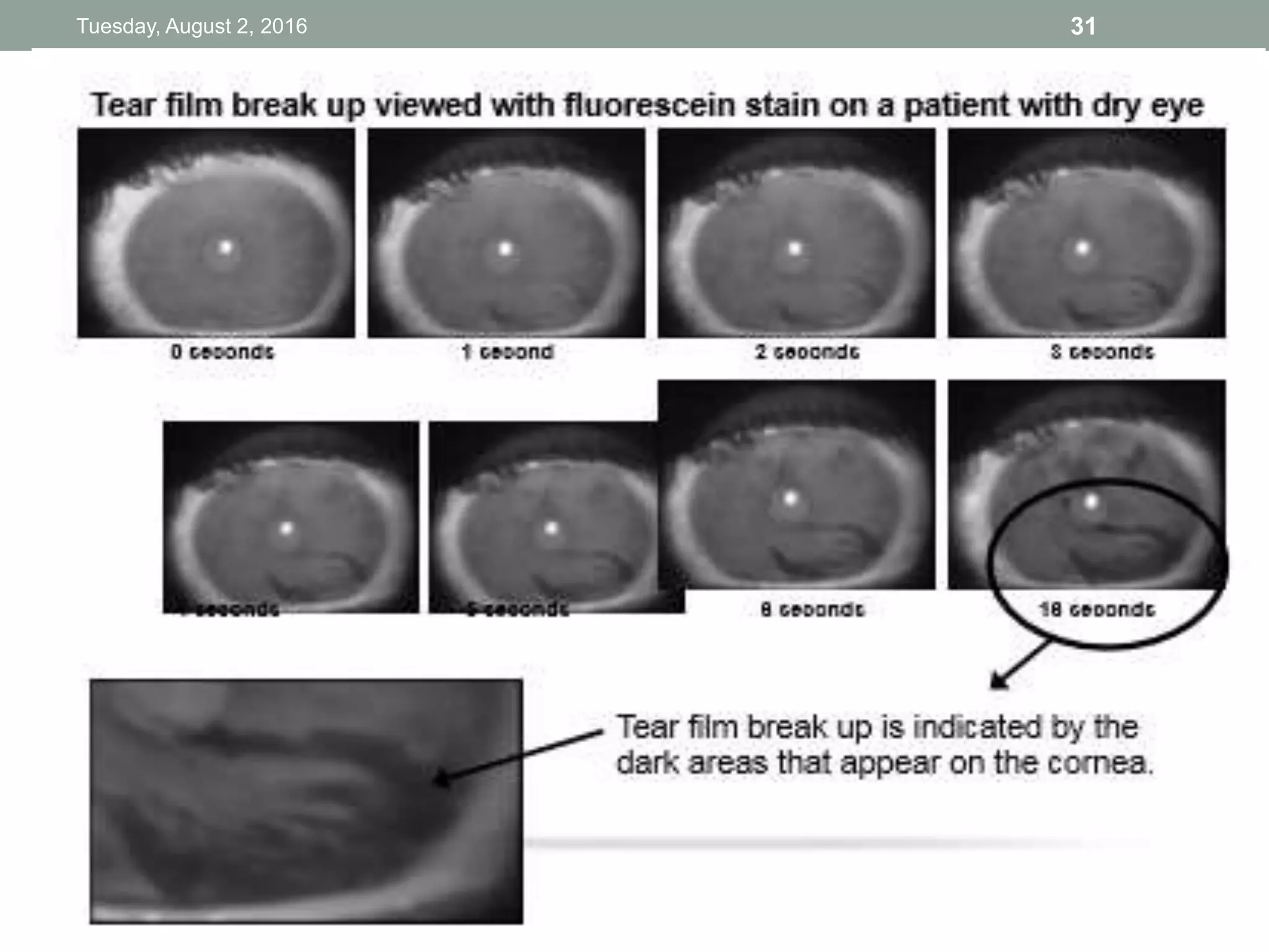 Corneal staining procedure | PPTX