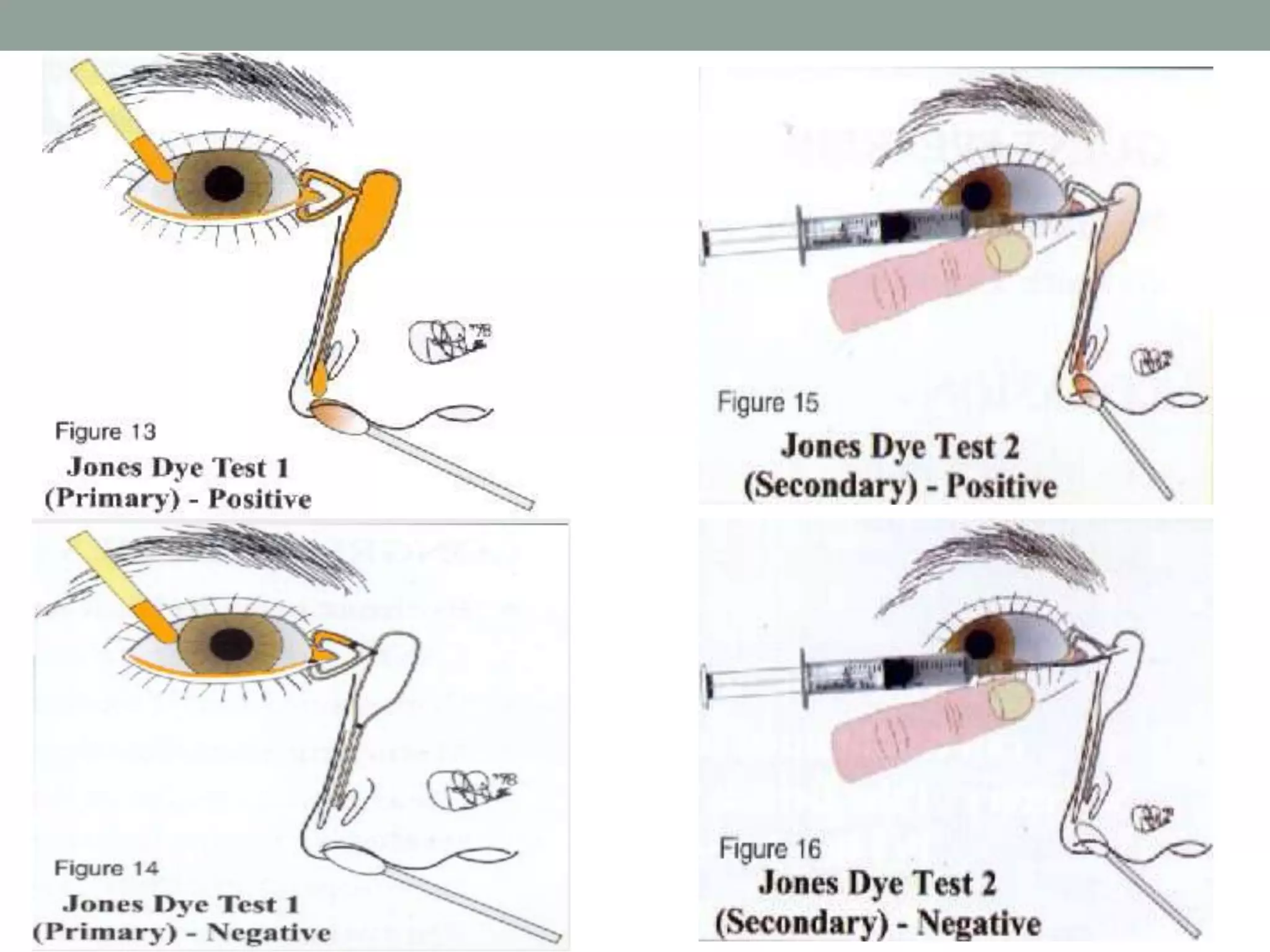 Corneal staining procedure