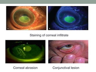 Corneal staining procedure | PPTX