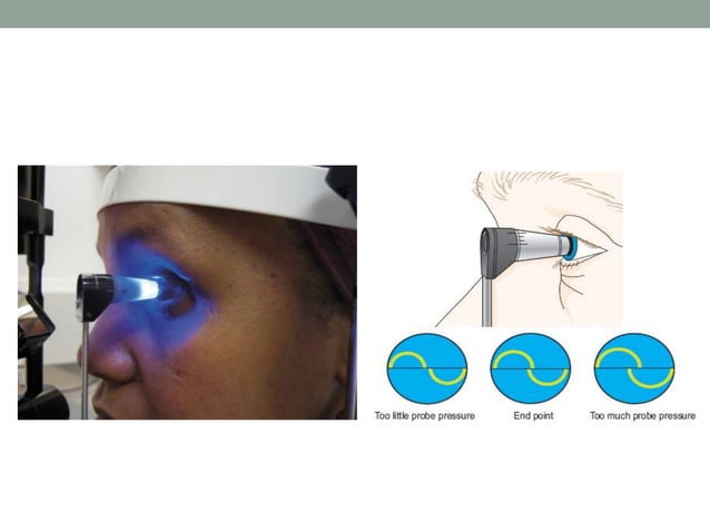 Corneal staining procedure | PPTX