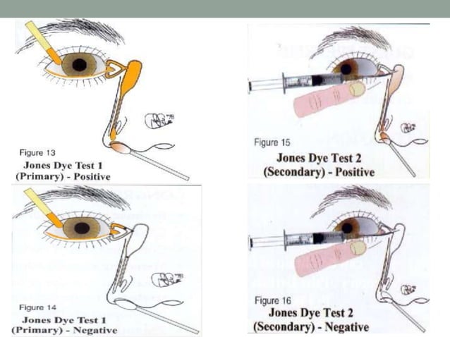 Corneal staining procedure | PPTX