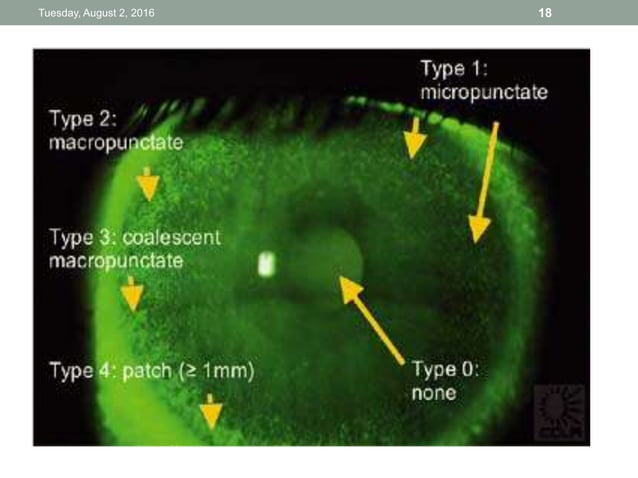 Corneal staining procedure