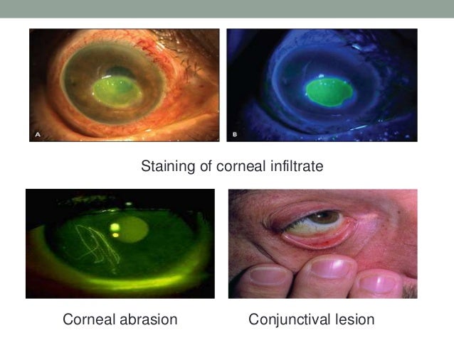 Corneal staining procedure